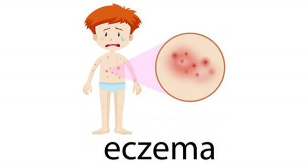 Types of Eczema: A Detailed Insight & Homeopathy Treatment