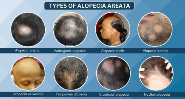 Types of Alopecia & Online Homoeopathic Treatment